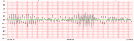 Defebrillierbare Rhythmen? (2x) | Notfallmedizin | Repetico