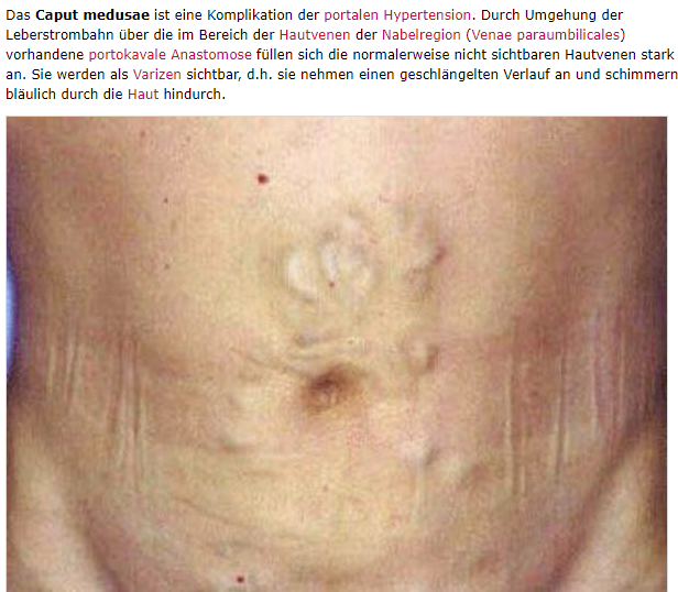 Was versteht man unter Caput Medusae? | Krankheitslehre I…