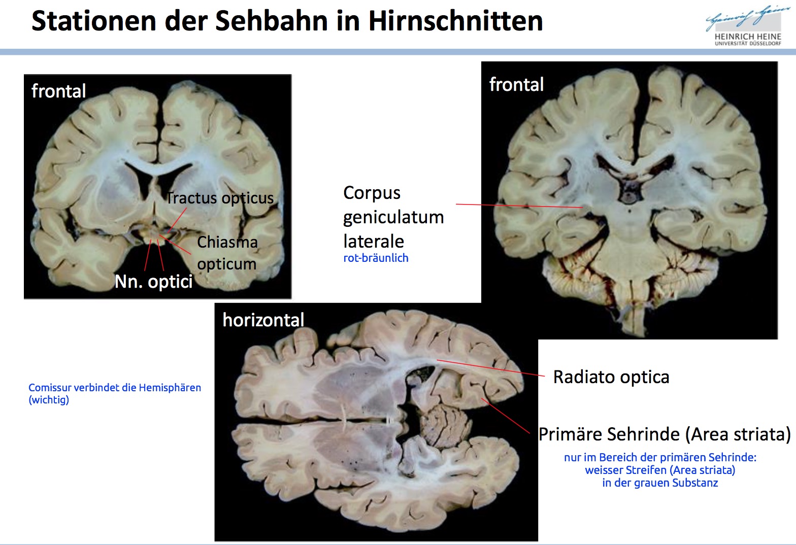 Sehbahn Welches Brodmann-Areal sind primäre und sekund ...