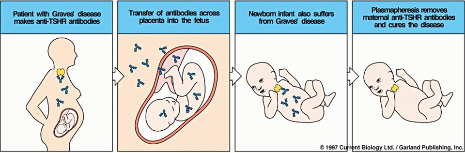 Was ist die Morbus Basedow-Krankheit? | Immu Rink | Repetico