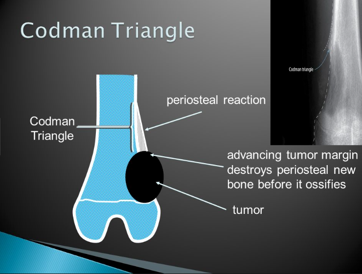 Codman triangle | Bewegungsapparat | Repetico