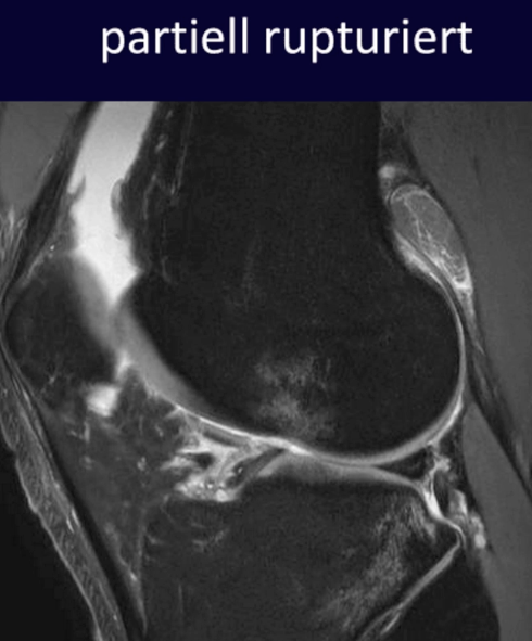 popliteofibulares Ligament (PFL) | Bewegungsapparat | Repetico