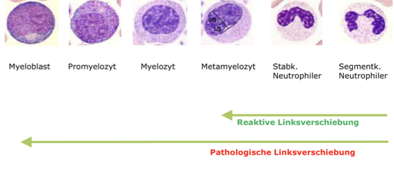 Definition reaktive und pathologische Linksverschiebung | Klin. Chemie ...