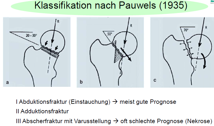 Oberschenkelhalsbruch, wie sieht er aus? | Grundlagen der Medizin für Ingenieure | Repetico