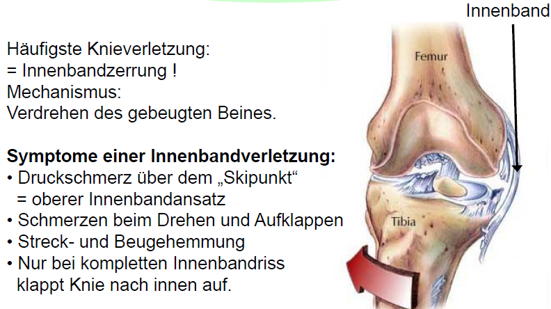 Was ist die häufigste Knieverletzung? Was sind Symptome... | Grundlagen der Medizin für ...