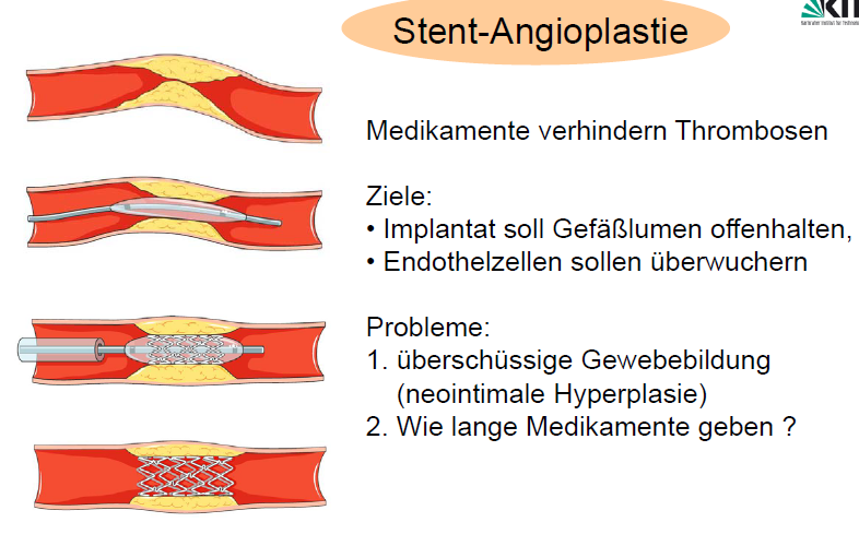 Was ist ein Stent? | Grundlagen der Medizin für Ingenieure | Repetico