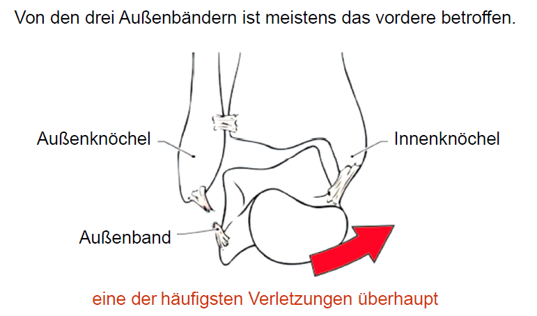 Was ist eine Sprunggelenksverletzung? Welche Teile sind ... | Grundlagen der Medizin für ...