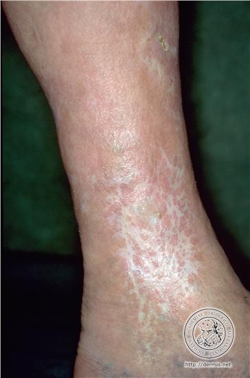 Atrophie blanche | Dermatologie II | Repetico