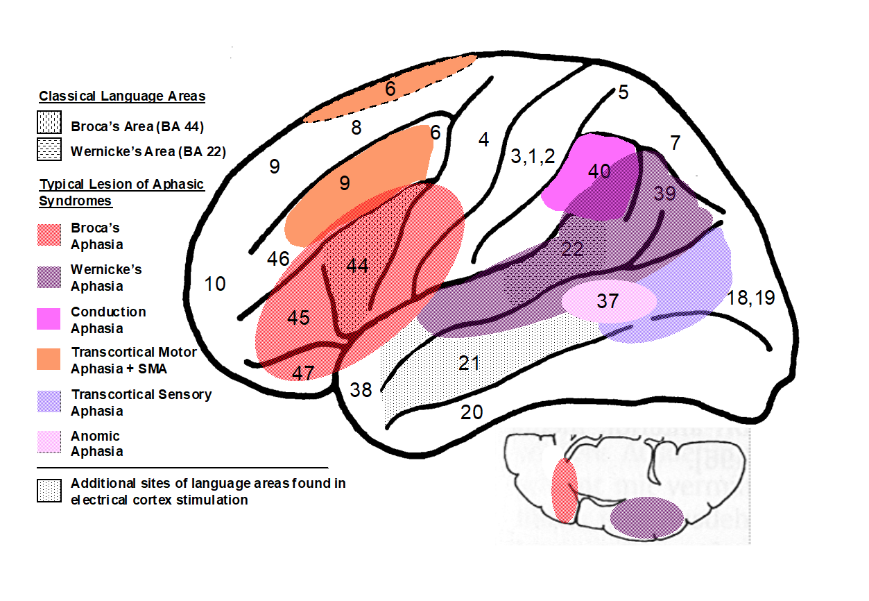 Typische Läsionen: Broca Aphasie | 07 Neuropsy Diagnostik A…