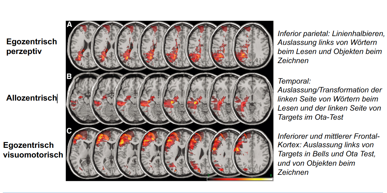 Vorsicht: die Resultate der Neglecttests können auch we... | 06 ...