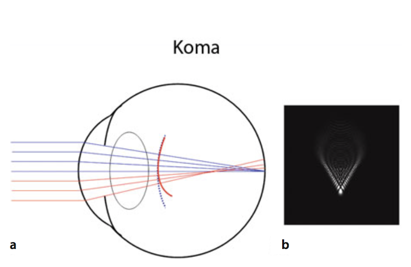 Koma - Entstehung, klinische Relevanz | Optik | Repetico